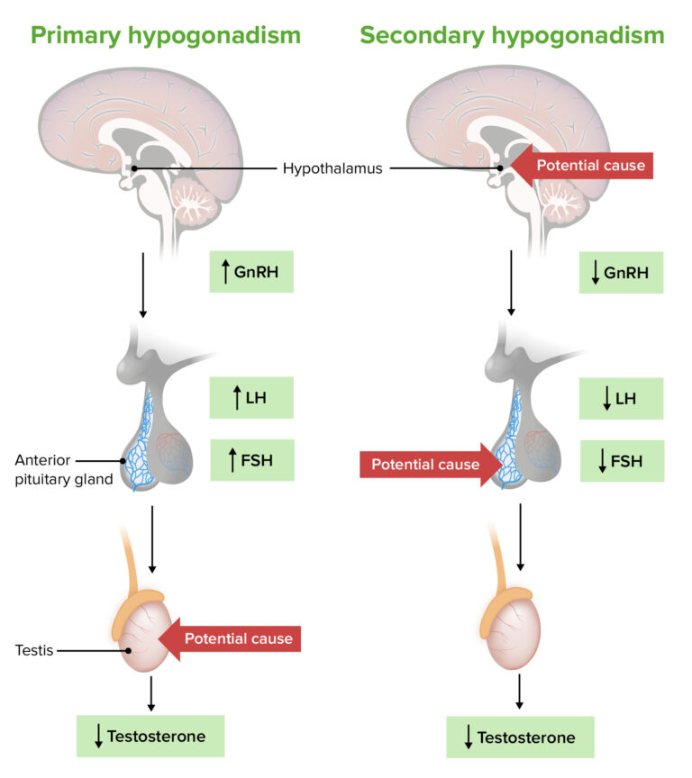 What is the difference between primary and secondary hypogonadism ...